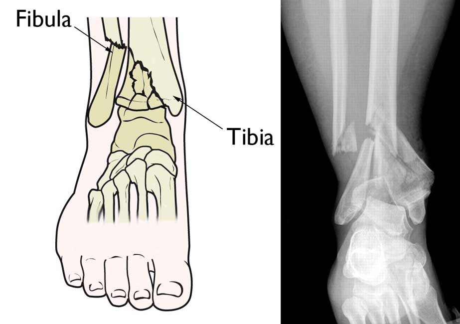 Distal Fibula Distal Fibula