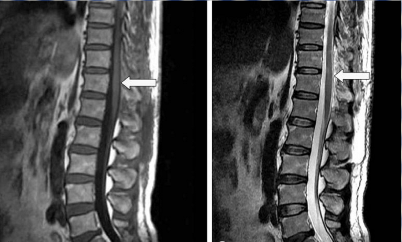 Equimosis O Hematoma Equimosis O Hematoma