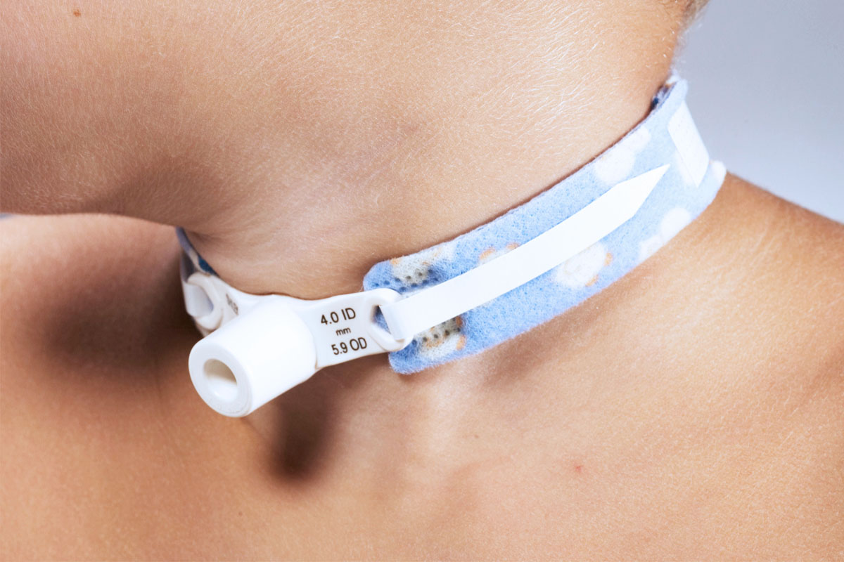 Common Tracheostomy Issues Core EM